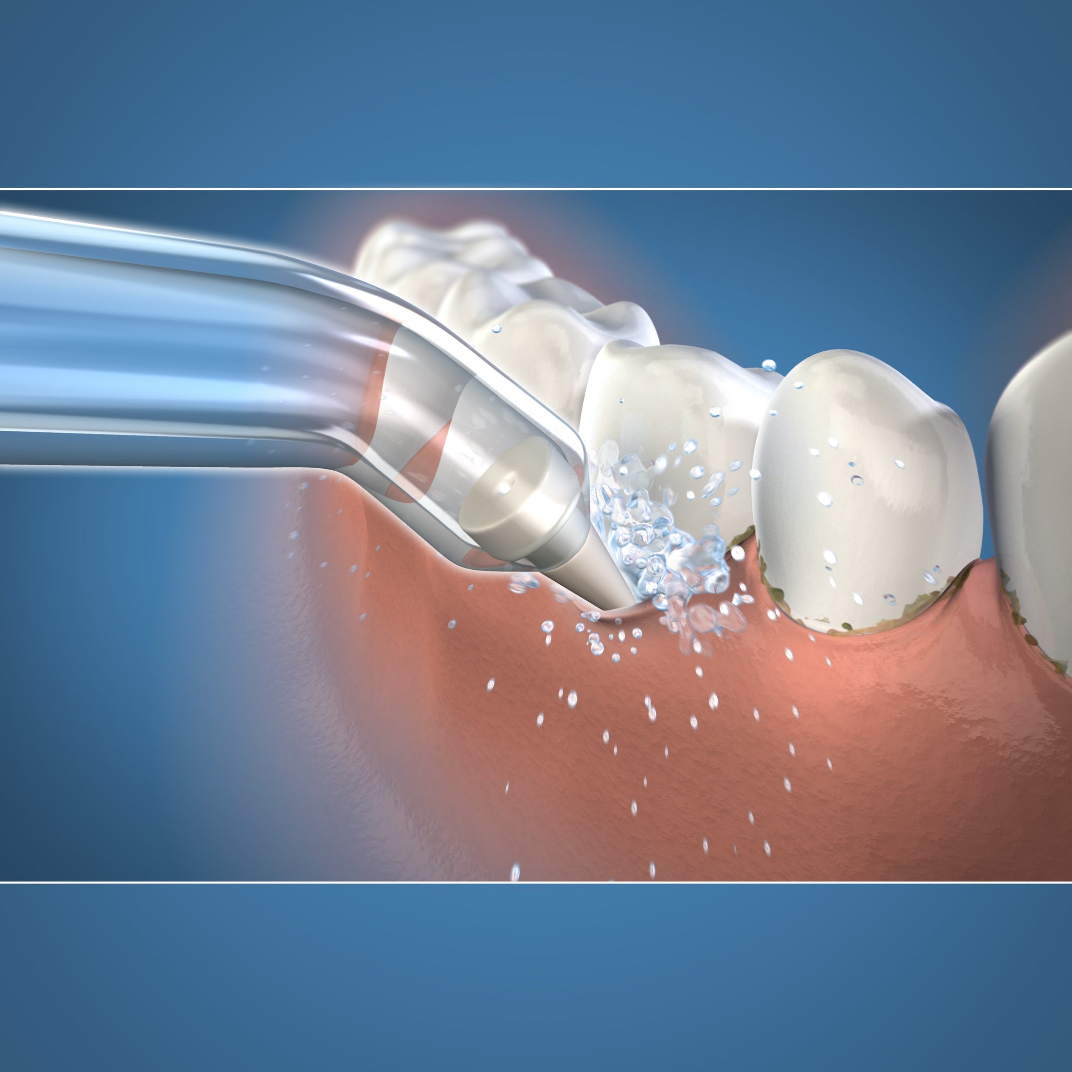 Waterpik Pik Pocket Tips | Water Flosser Replacement Tips